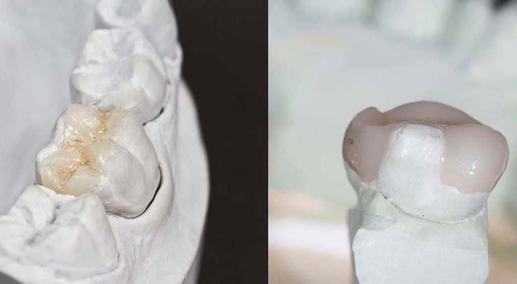 Inlays and Onlays - Aesthetics in Dentistry